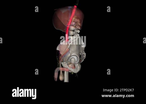 An abdominal aortic aneurysm is an enlarged area in the lower part of ...