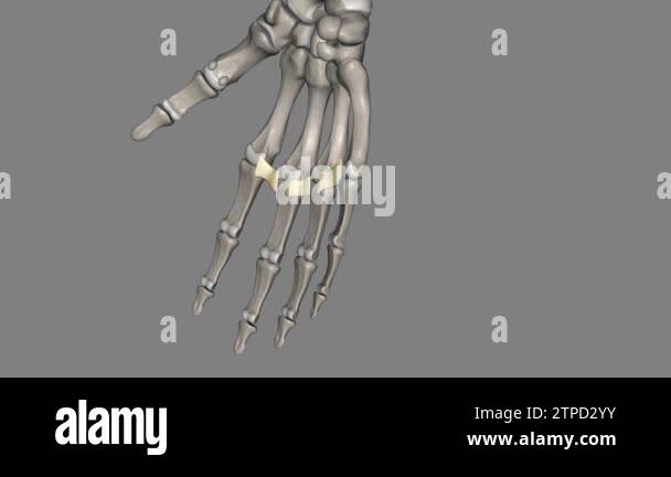 The deep transverse metacarpal ligament connects the palmar surfaces of ...