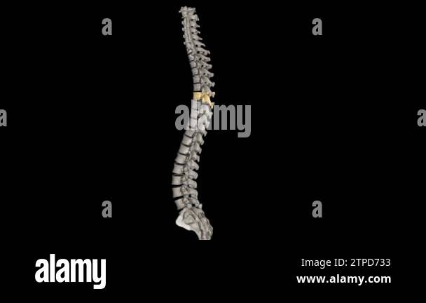 Twelve vertebrae are located in the thoracic spine and are numbered T-1 ...