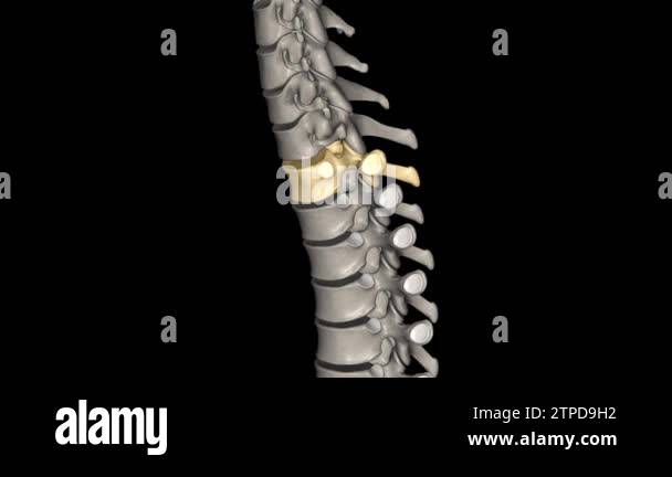 The L4 and L5 are the lowest vertebrae, or spinal bones, in the lumbar ...