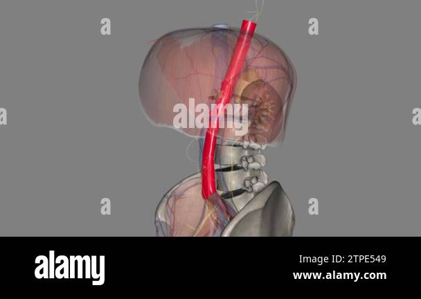An abdominal aortic aneurysm is an enlarged area in the lower part of ...