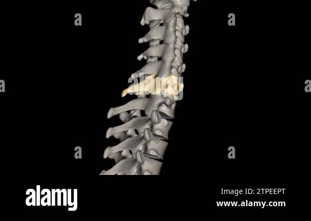 The C6 spinal vertebra is part of the cervical spinal cord, located in ...