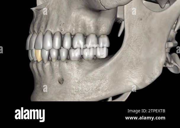 The mandibular lateral incisor is the tooth located distally from both ...