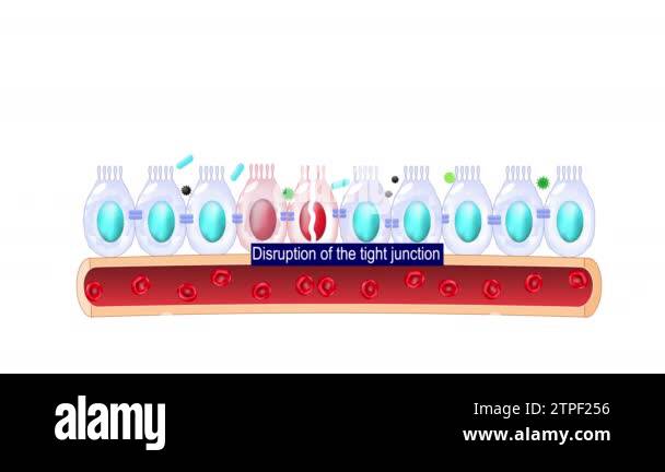 Leaky gut Syndrome. difference between Healthy cells, and inflamed ...