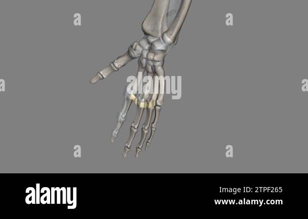 The deep transverse metacarpal ligament connects the palmar surfaces of ...