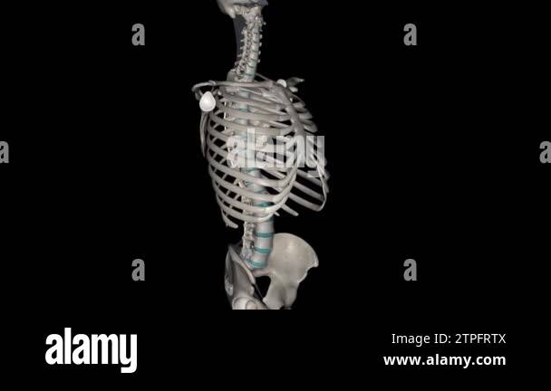 The intertransverse ligaments comprise sheets of connective tissue that ...