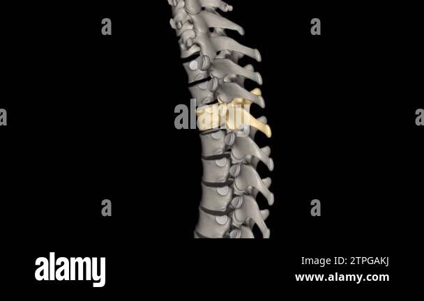 Twelve vertebrae are located in the thoracic spine and are numbered T-1 ...