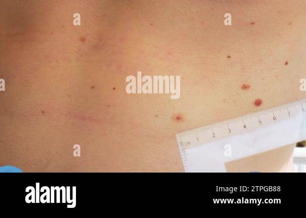 Dermatologist checking male birthmarks with ruler. Doctor examining ...