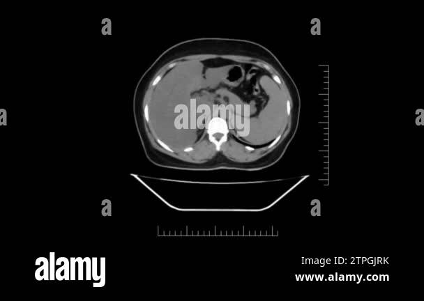 CT scan of the abdomen. Computed tomography of the gastrointestinal ...