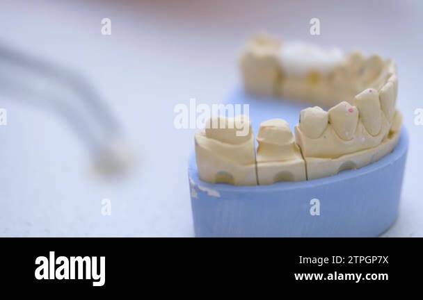 Placement of a dental crown on a jaw model. The doctor puts an ...