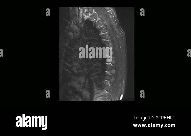 Computed medical tomography MRI scan of the thoracic spine of a man ...