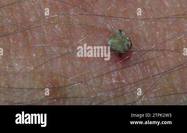 Bees venom sac. Honey bee stings a mans arm. When the sting is over ...