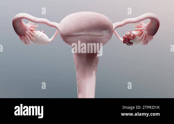 Ovarian Malignant Tumor Female Uterus Anatomy Reproductive System