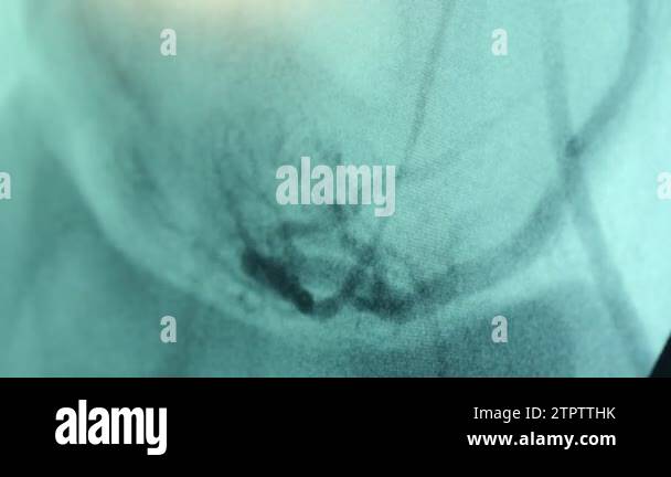 Blue screen of a modern Xray scanner examining a breast with black ...