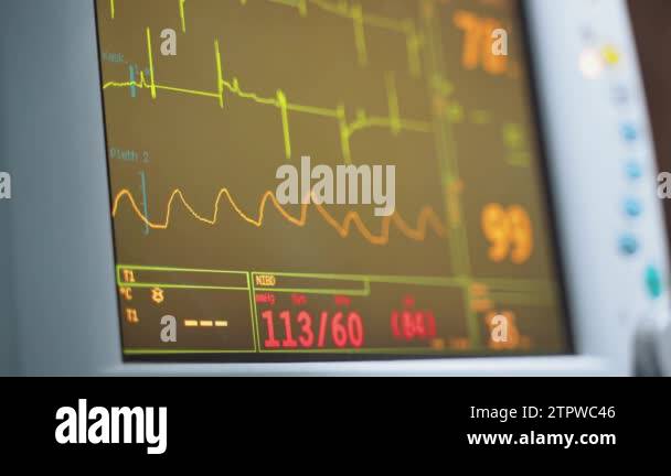 ECG monitor in operating room. Colorful waves on the screen of a ...