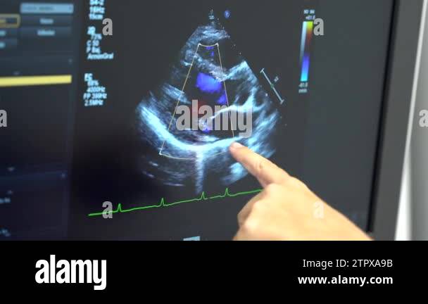 Echocardiogram machine Stock Videos & Footage - HD and 4K Video Clips ...