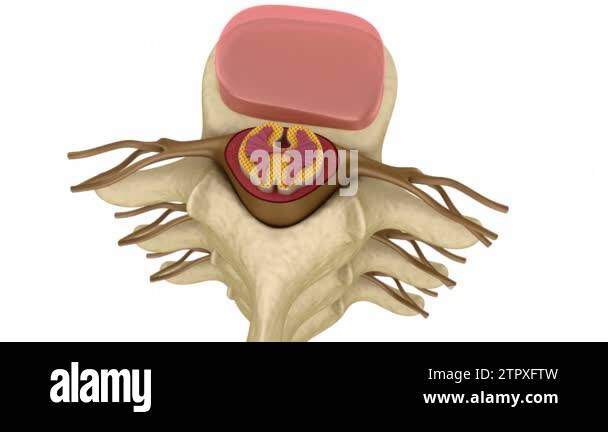Slipped intervertebral disc Stock Videos & Footage - HD and 4K Video ...