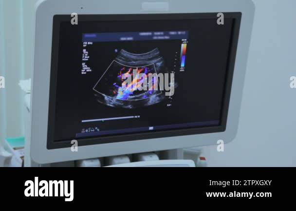 Kidney blood vessels Stock Videos & Footage - HD and 4K Video Clips - Alamy