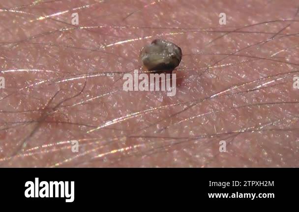 Bees venom sac. Honey bee stings a mans arm. When the sting is over ...