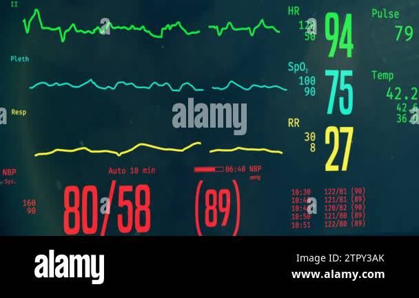 Patient dying in hospital, ICU monitor with dropping vital signs ...