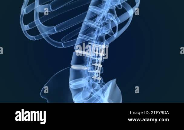 Surgical fixation Stock Videos & Footage - HD and 4K Video Clips - Alamy