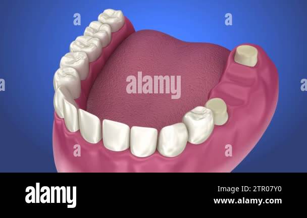 Tooth supported fixed bridge instalation process . Medically accurate ...