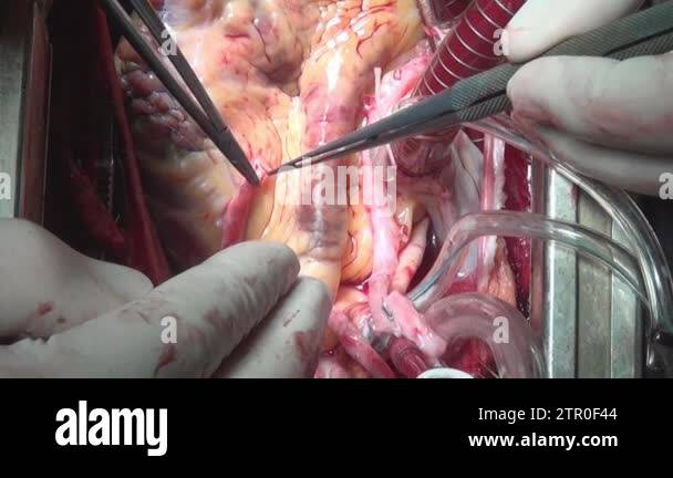 Heart surgery on live organ Stock Videos & Footage - HD and 4K Video ...