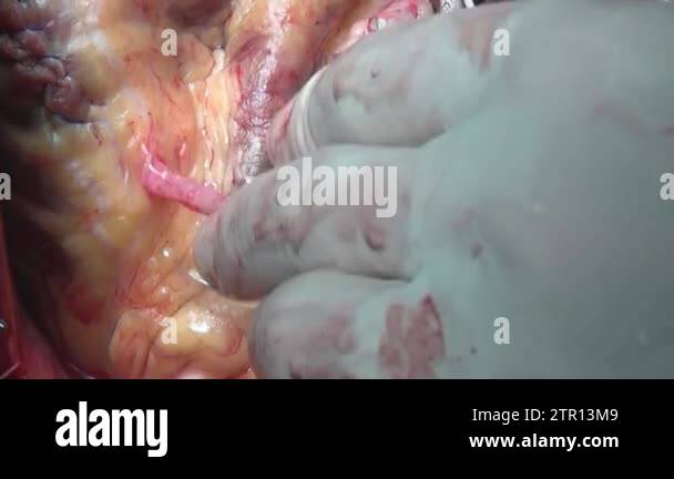 Heart during operation on live organ of person in clinic Stock Video ...