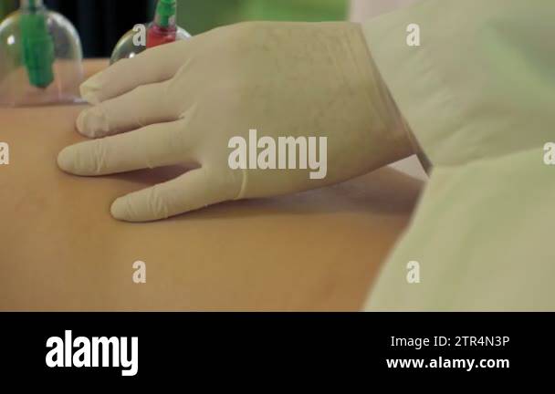 Traditional Chinese Medicine Cupping process. Hijamah Cups on back of ...