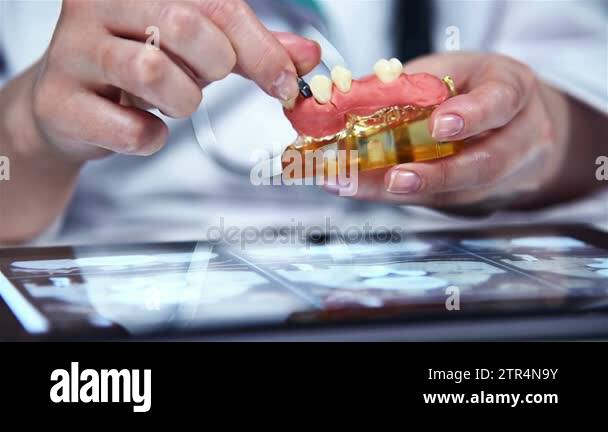 Dentist Shows Model Of Dental Prosthesis With Implant. Close Up Stock ...