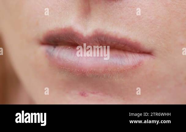 female lips with bruise. close-up. effects of hyaluronic acid. lip ...