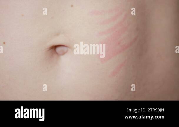 hyperemia. an allergic reaction to the body. hives. red spots on the ...