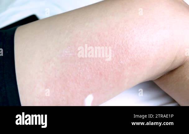 Allergic rash dermatitis eczema on skin. Application of the drug for external use on atopic ...