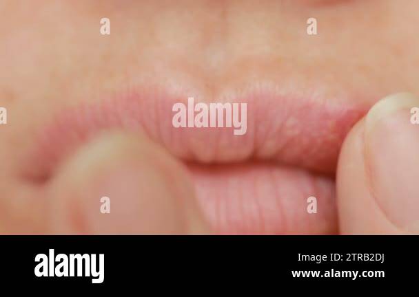 girl touching sores on the lips. herpes. lip treatment Stock Video ...