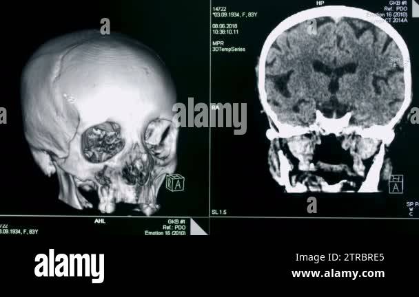Skull model rotates on a screen, close up. Medical machine creates a ...