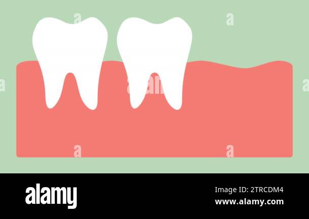 wisdom tooth ( distal impaction ) - dental cartoon vector flat style ...