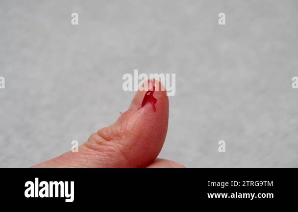 Cut thumb Stock Videos & Footage - HD and 4K Video Clips - Alamy
