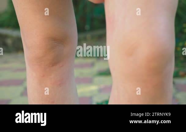 Scratch soft itchy red bumps on the skin from mosquito bites on leg ...