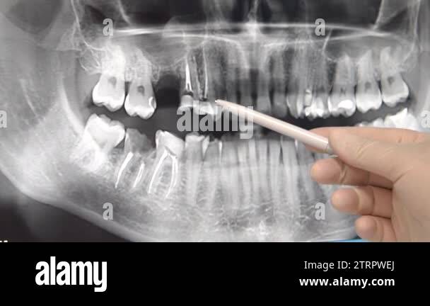 Roentgen teeth Stock Videos & Footage - HD and 4K Video Clips - Alamy