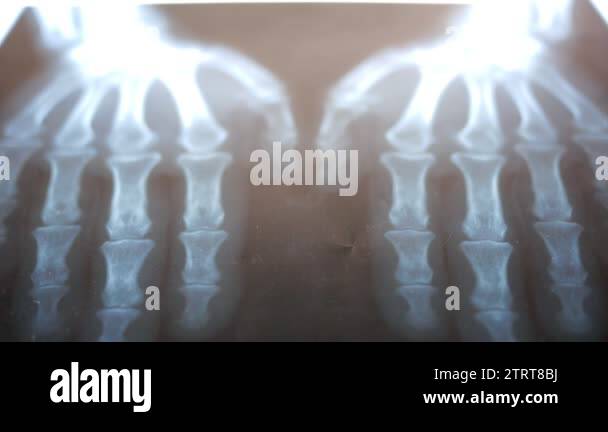 Roentgen radiogram Stock Videos & Footage - HD and 4K Video Clips - Alamy