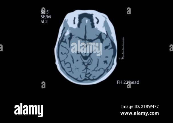 Brain MRT scan. One view on the black screen. 4k medical background ...