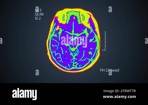 Brain MRT scan. One view on the screen. 4k medical colorful background ...