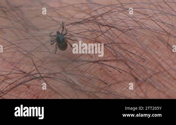 Sheep tick nymph Stock Videos & Footage - HD and 4K Video Clips - Alamy