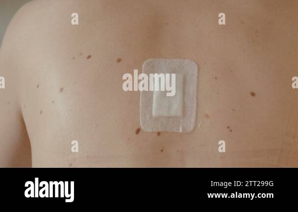 Peeling the patch on scar after removal of surgical sutures. Large ...