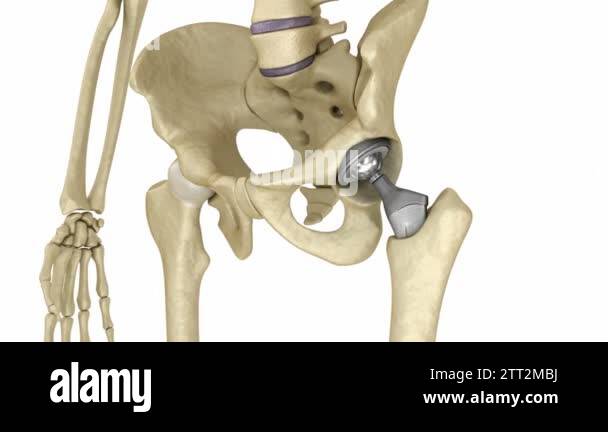 Hip replacement implant installed in the pelvis bone. Medically ...