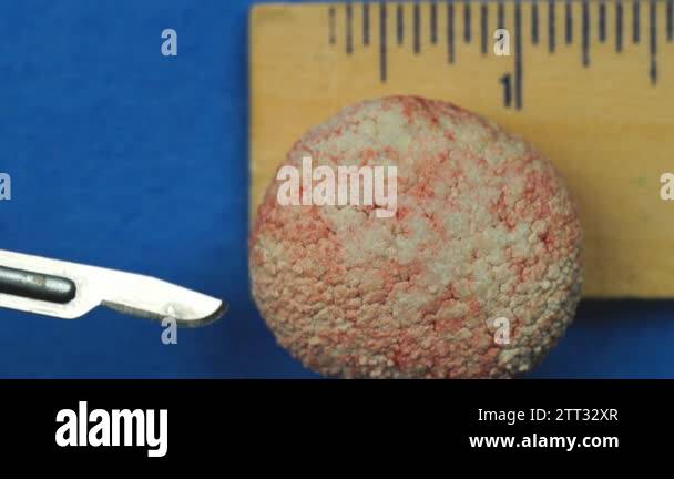 Bladder stone Stock Videos & Footage - HD and 4K Video Clips - Alamy
