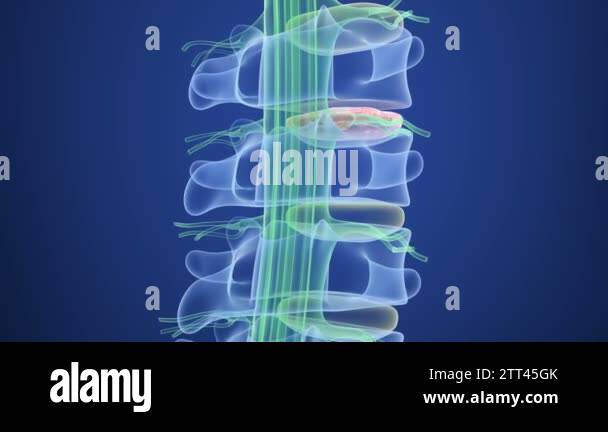 Herniated disc x ray Stock Videos & Footage - HD and 4K Video Clips - Alamy
