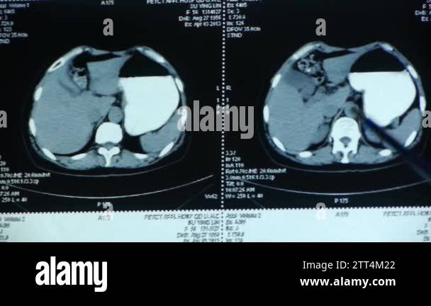 Pet scan abdomen tumor Stock Videos & Footage - HD and 4K Video Clips ...