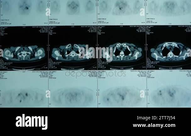 human subclavian pet-ct scan,lymph nodes X-ray,Cancer metastasis Stock ...