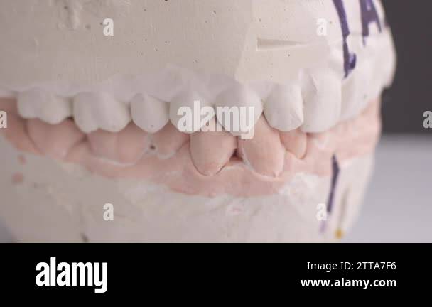 Wax rollers on the tooth model for determining jaw closure Stock Video ...